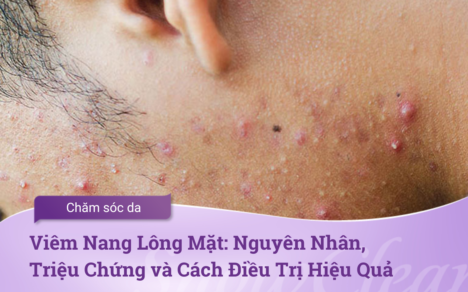 Viêm Nang Lông Mặt: Nguyên Nhân, Triệu Chứng và Cách Điều Trị Hiệu Quả