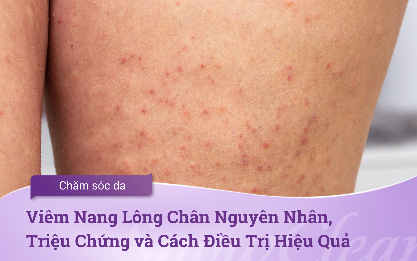Viêm Nang Lông Chân Nguyên Nhân, Triệu Chứng và Cách Điều Trị Hiệu Quả