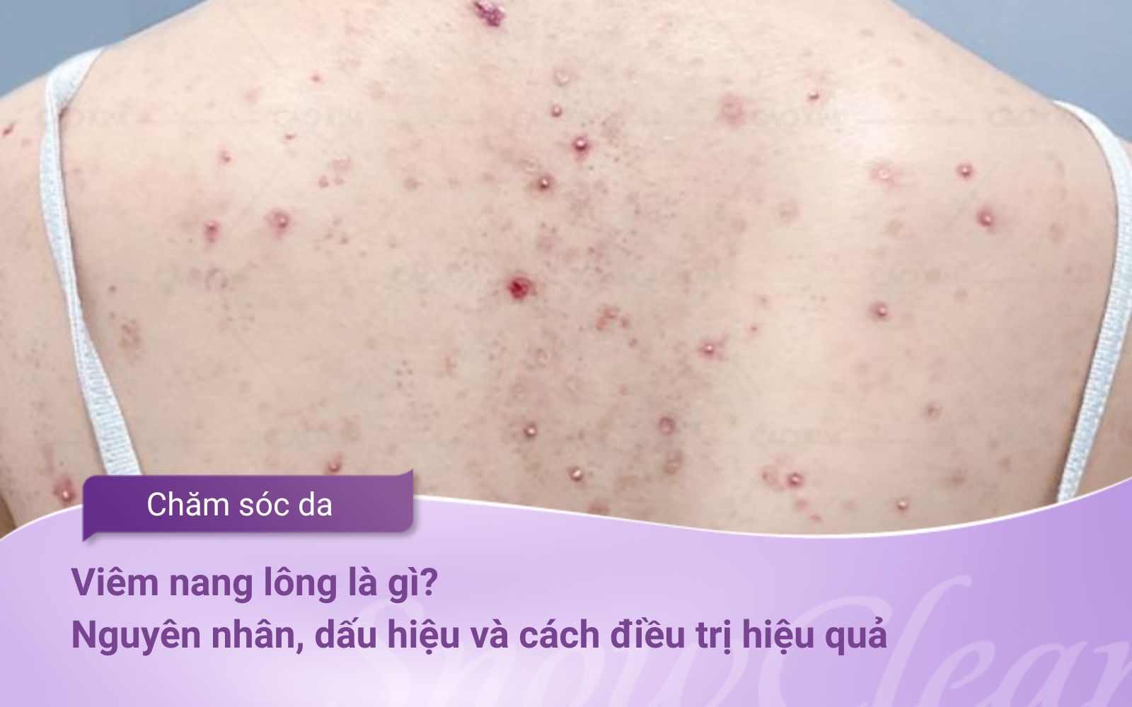 Viêm nang lông là gì? Nguyên nhân, dấu hiệu và cách điều trị hiệu quả
